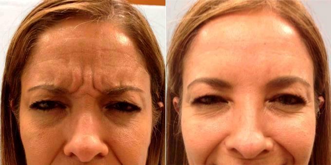 35 Year Old Woman Treated With Botox With Dr. Jose Rodríguez-Feliz, MD ...