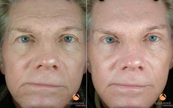 Dr. Amy Forman Taub, MD, Chicago Dermatologic Surgeon – Male Patient ...